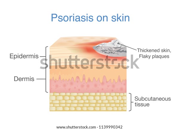 Illustration of human skin layer when plaque psoriasis signs and ...