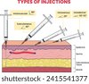 1+ Hundred Intramuscular Injection Sites Royalty-Free Images, Stock ...