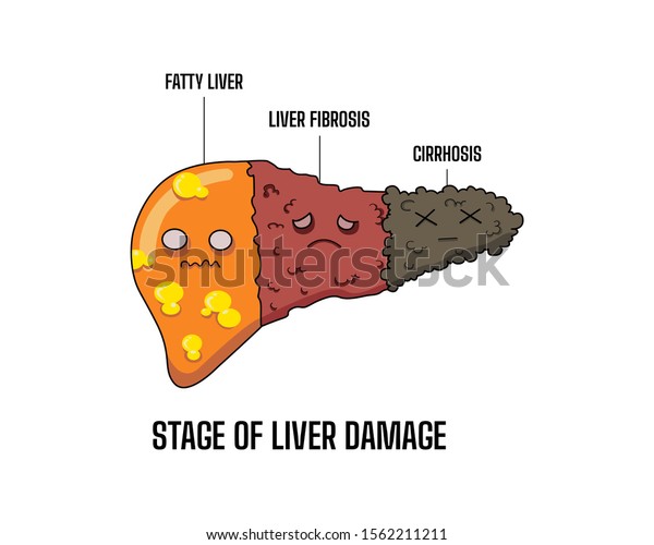 Illustration Liver Damage Concept Fatty Liver Stock Vector (Royalty ...
