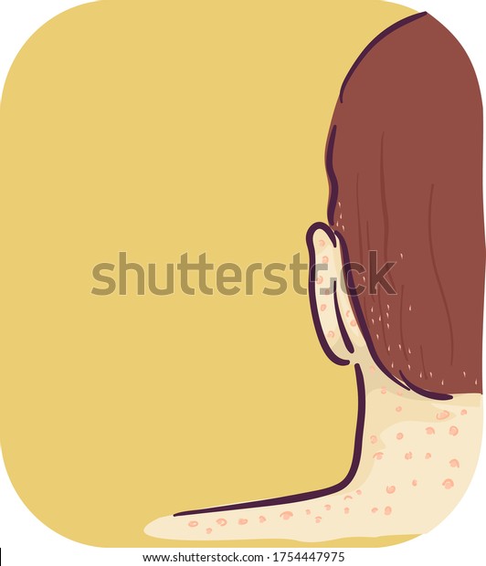 Illustration Man Red Bumps On Head Stock Vector (Royalty Free ...