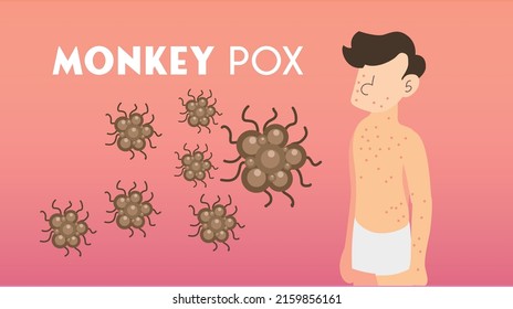 Illustration Monkeypox Virus Vector Person Monkeypox Stock Vector ...