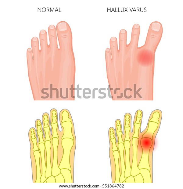Illustration Normal Foot Hallux Varus Used 库存矢量图（免版税）551864782 ...