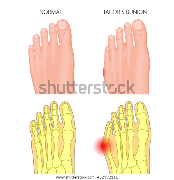 Illustration Normal Foot Tailors Bunion External Stock Vector (Royalty ...