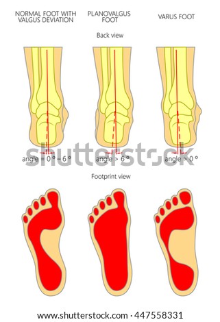 Illustration Normal Planovalgus Varus Feet Footprint Arkistovektori ...