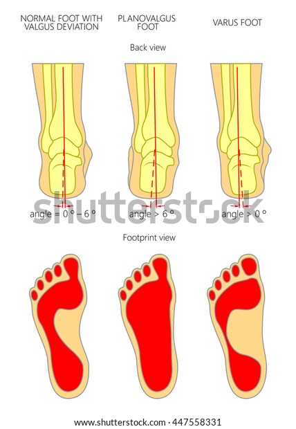 Hakuun Illustration Normal Planovalgus Varus Feet Footprint liittyvä ...