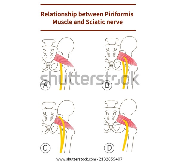 Illustration Piriformis Sciatic Nerve: Vector có sẵn (miễn phí bản ...