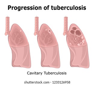 Illustration Progression Cavitary Pulmonary Tuberculosis Stock Vector ...