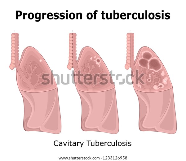 Illustration Progression Cavitary Pulmonary Tuberculosis Stock Vector ...
