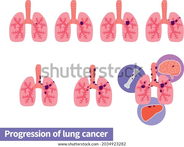 Illustration Set Lung Cancer Progression Stock Vector (Royalty Free ...