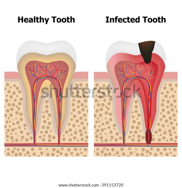 Illustration Showing Pulpitis Healthy Tooth Vector: стоковая векторная ...