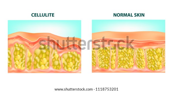Illustration Skin Cross Section Cellulite Formation Stock Vector ...