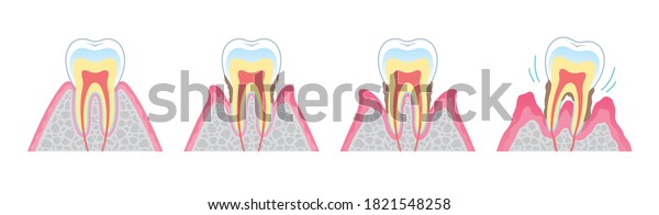 Illustration That Explains Structure Periodontal Disease Stock Vector ...