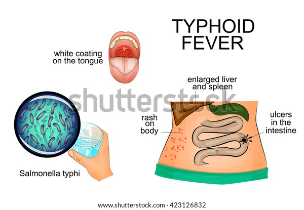Illustration Typhoid Fever Infographics Pathogen Symptoms Stock Vector ...