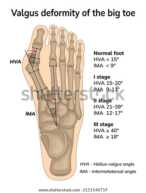 Illustration Valgus Deformity Big Toe Angles: stockvector (rechtenvrij ...