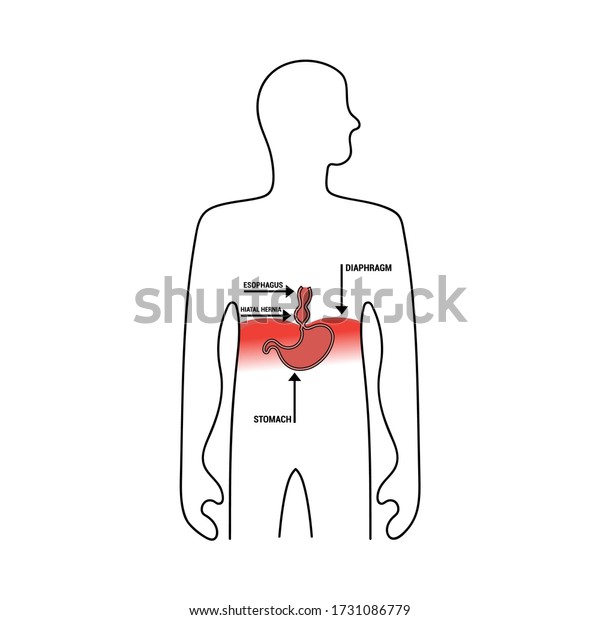 Image Hiatus Hernia Descriptive Icon Disease Stock Vector (Royalty Free ...