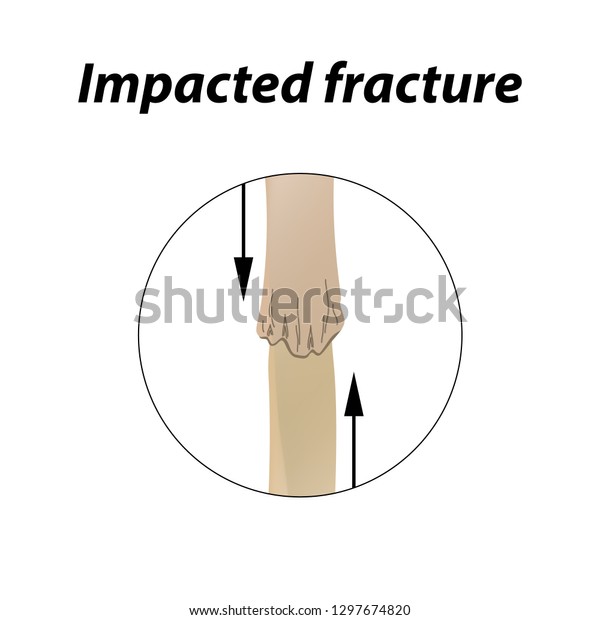 Impacted Fracture Bone Infographics Vector Illustration Stock Vector ...
