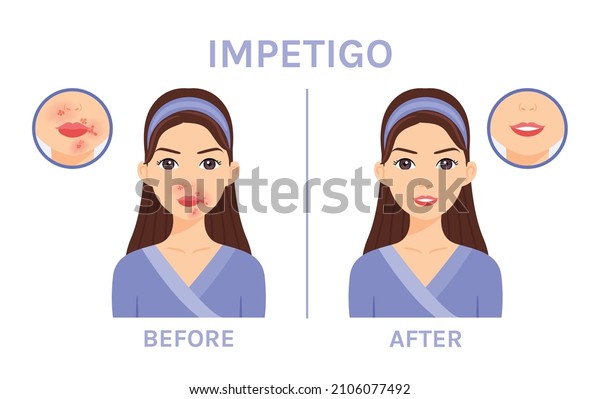 Impetigo Treatment Skin Diseases Problem On Stock Vector (Royalty Free ...