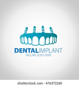 Implant Logo Stock Vector (Royalty Free) 476372260 | Shutterstock