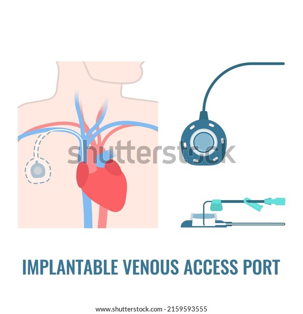 83 Patient Medication Port Images, Stock Photos & Vectors | Shutterstock