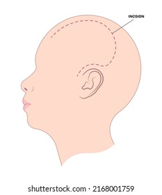 Incision Stock Vectors, Images & Vector Art | Shutterstock