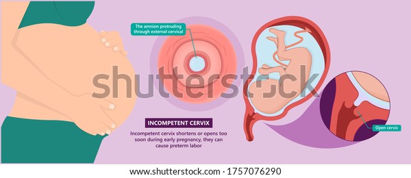 Incompetent Cervix Cervical Insufficiency Weak Tissue Stock Vector ...