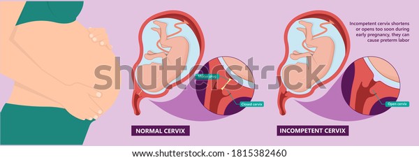 Incompetent Cervix Cervical Insufficiency Weak Tissue Stock Vector ...