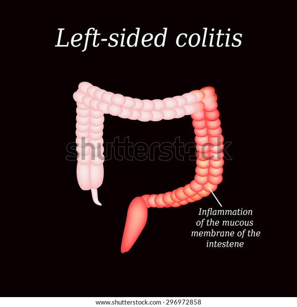 Inflammation Large Intestine Divisions Vector Illustration Stock Vector ...