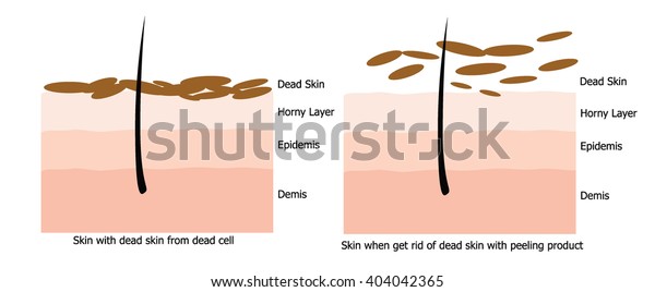 Infographic About Dead Skin On Human: เวกเตอร์สต็อก (ปลอดค่าลิขสิทธิ์ ...