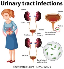 Informative Illustration Urinary Tract Infections Illustration Stock ...