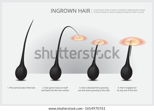 Ingrown Hair Structure Vector Illustration Stock Vector Royalty Free