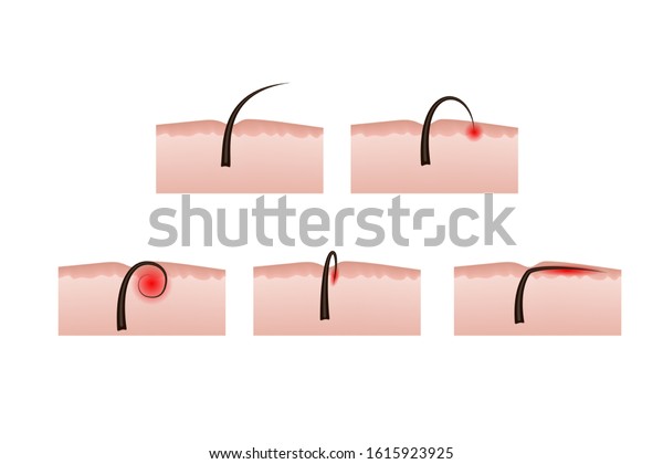 Ingrown Hairs After Depilation Vector Illustration 库存矢量图（免版税）1615923925