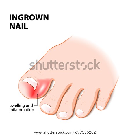 Ingrown Nail Onychocryptosis Nail Disease Stock Vector (Royalty Free ...