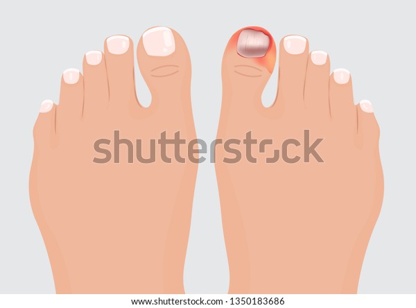 Ingrown Toenail Vector Illustration Stock Vector (Royalty Free ...