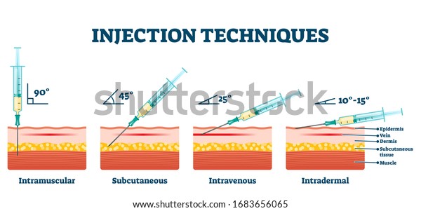 Injection Techniques Vector Illustration Labeled Educational Stock ... Injection Techniques Vector Illustration Labeled Educational Stock ...
