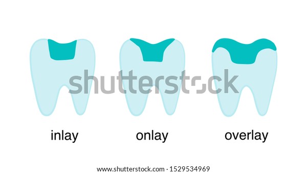 Inlay Onlay Overlay Tooth Crown Restoration: vetor stock (livre de ...
