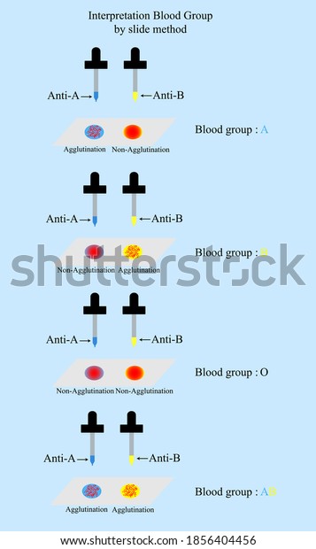 Interpretation blood group in ABO System by slide method in laboratory