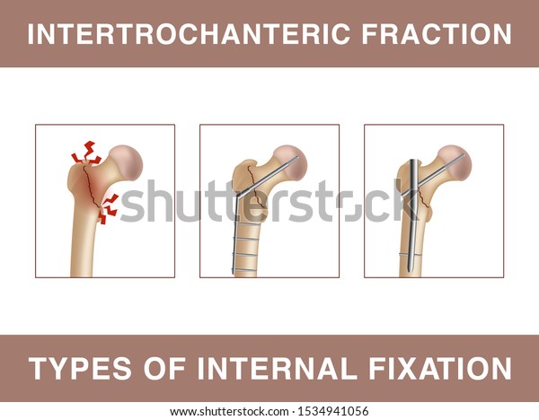 Intertrochanteric Fracture Types Internal Fixation Vector Stock Vector ...