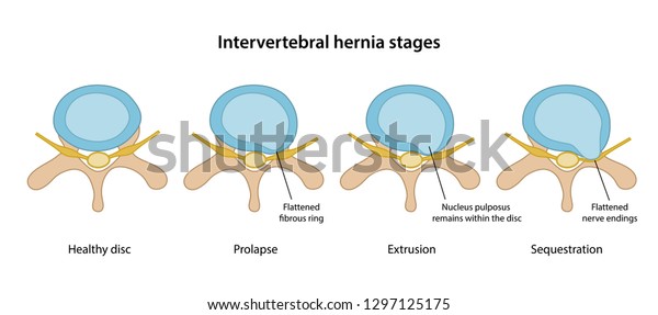 Intervertebral hernia stages: healthy disc, prolapse, extrusion ...