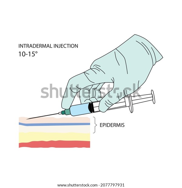 Intradermal Injection Effective Methods Administration Drugs Stock