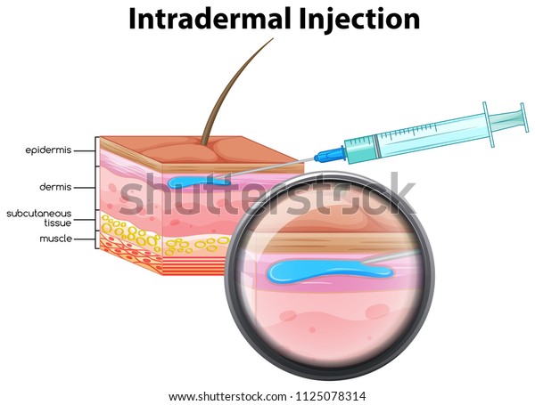 Intradermal Injection on White Background illustration