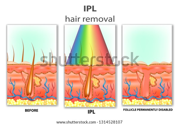 Ipl Intense Pulsed Light How Ipl Stock Vector (Royalty Free) 1314528107 ...