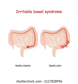 Diagram Shows Types Ulcerative Colitis Proctitis Stock Illustration ...
