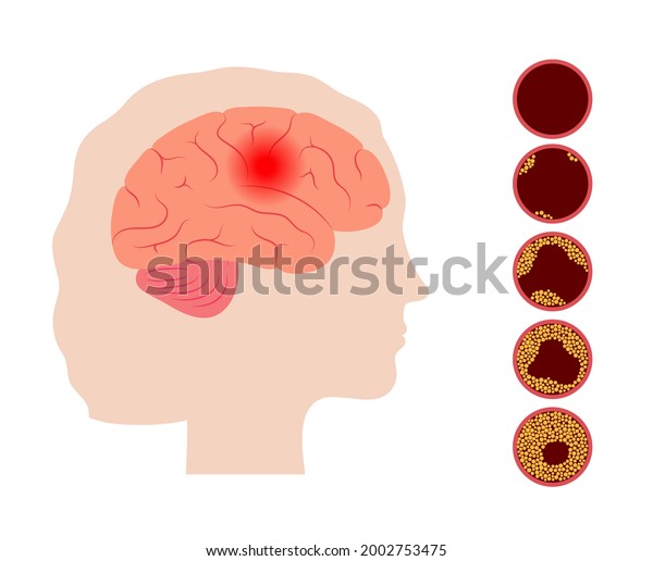 Ischemic Brain Stroke Arteriosclerosis Human Head Stock Vector (Royalty ...