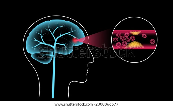 Ischemic Brain Stroke Arteriosclerosis Infarct Tia Stock Vector ...