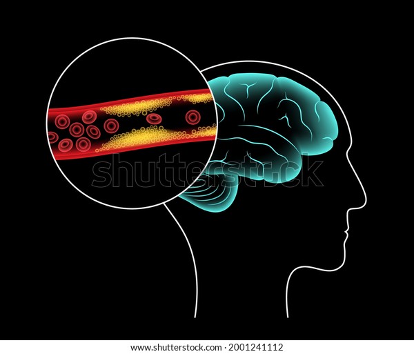 Ischemic Brain Stroke Arteriosclerosis Infarct Tia Stock Vector ...