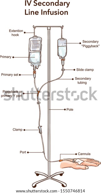 Iv Secondary Line Infusion Vector Illustration Stock Vector (Royalty ...