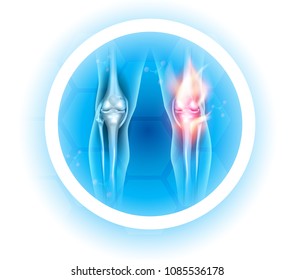 Joint Problems Symbol Transparent Legs Joints Stock Vector (Royalty ...