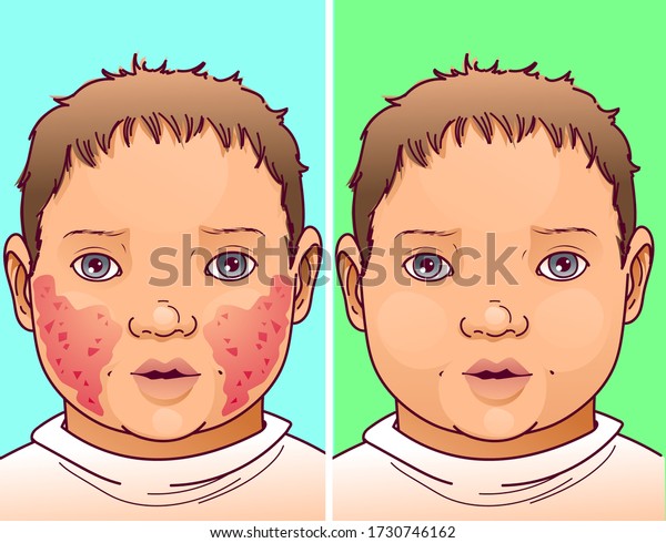Kid Unhealthy Face Before After Stock Vector (Royalty Free) 1730746162 ...