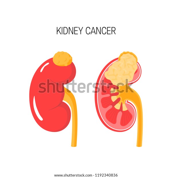 Kidney Cancer Concept Vector Illustration Flat Stock Vector (Royalty ...