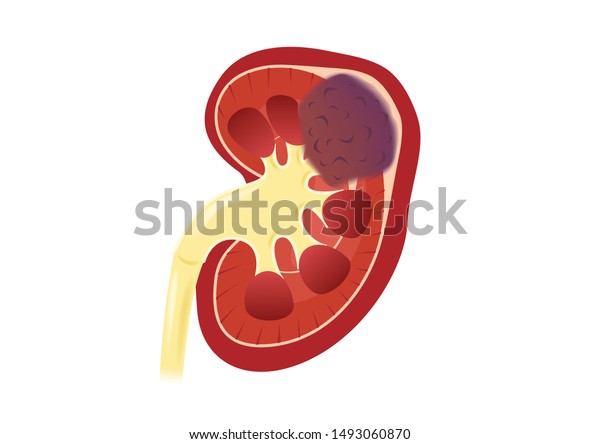Kidney Cell Cancer Vector On White Stock Vector (Royalty Free ...
